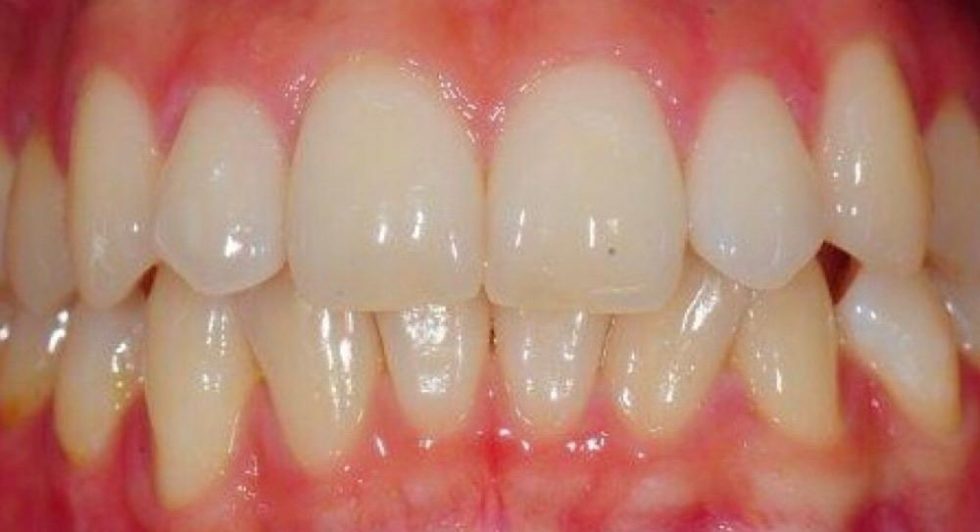 Book Advanced Teeth Whitening in Pretoria & Johannesburg