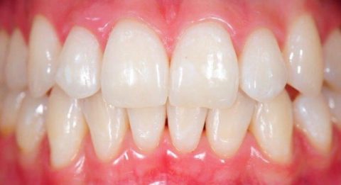 Book Advanced Teeth Whitening in Pretoria & Johannesburg