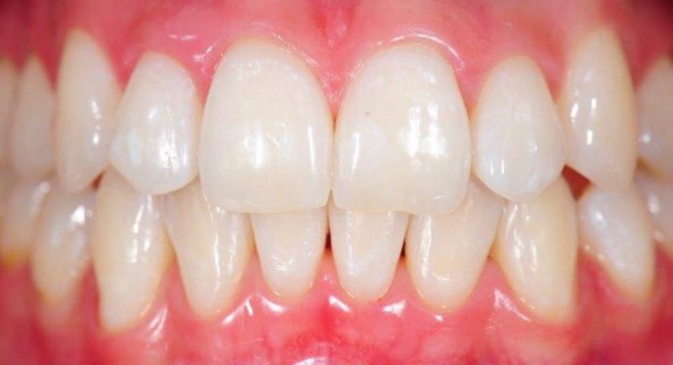Book Advanced Teeth Whitening in Pretoria & Johannesburg