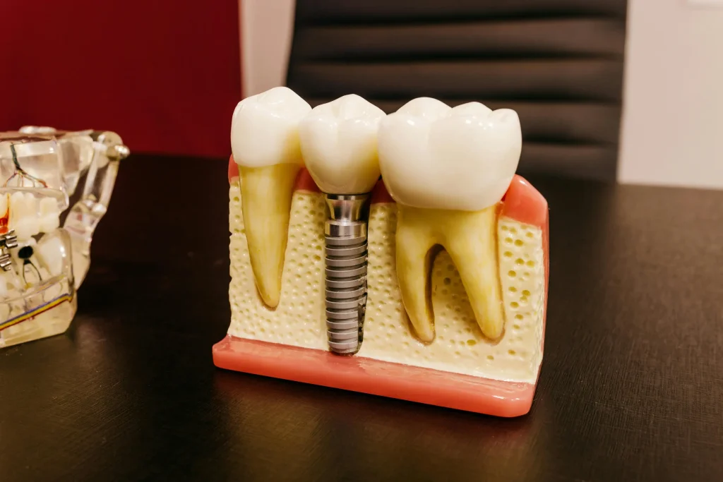 Dental Implants | How Long is The Process? 5-10 Min p/Tooth